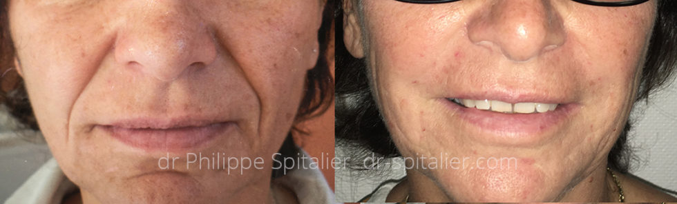 sillons nasogéniens Annecy | Docteur Spitalier