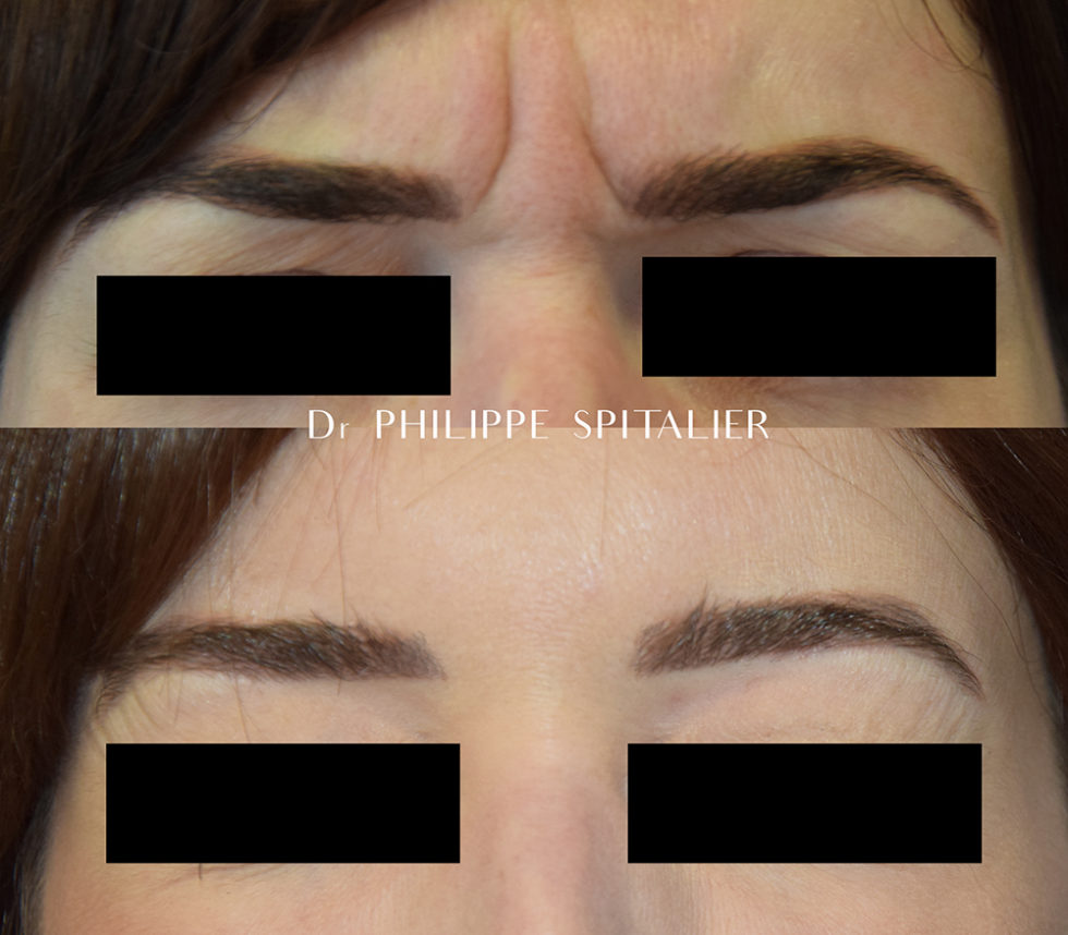 ALLUZIENCE:une révolution dans la toxine botulique | Docteur Spitalier