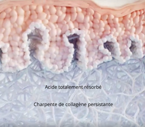HArmonyCa la révolution des injectables hybrides | Docteur Spitalier